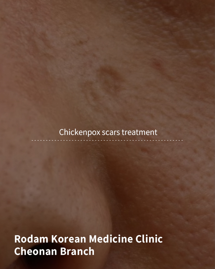 Treatment Review for Chickenpox Scars at Rodam Korean Medicine Clinic ...