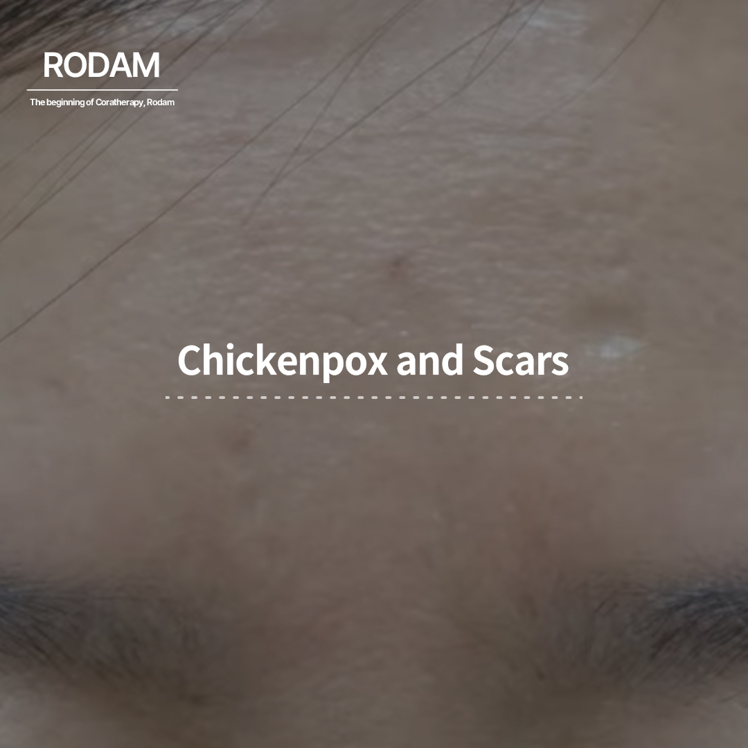 Causes of Chickenpox and Treatment of Chickenpox Scars at Rodam Korean ...