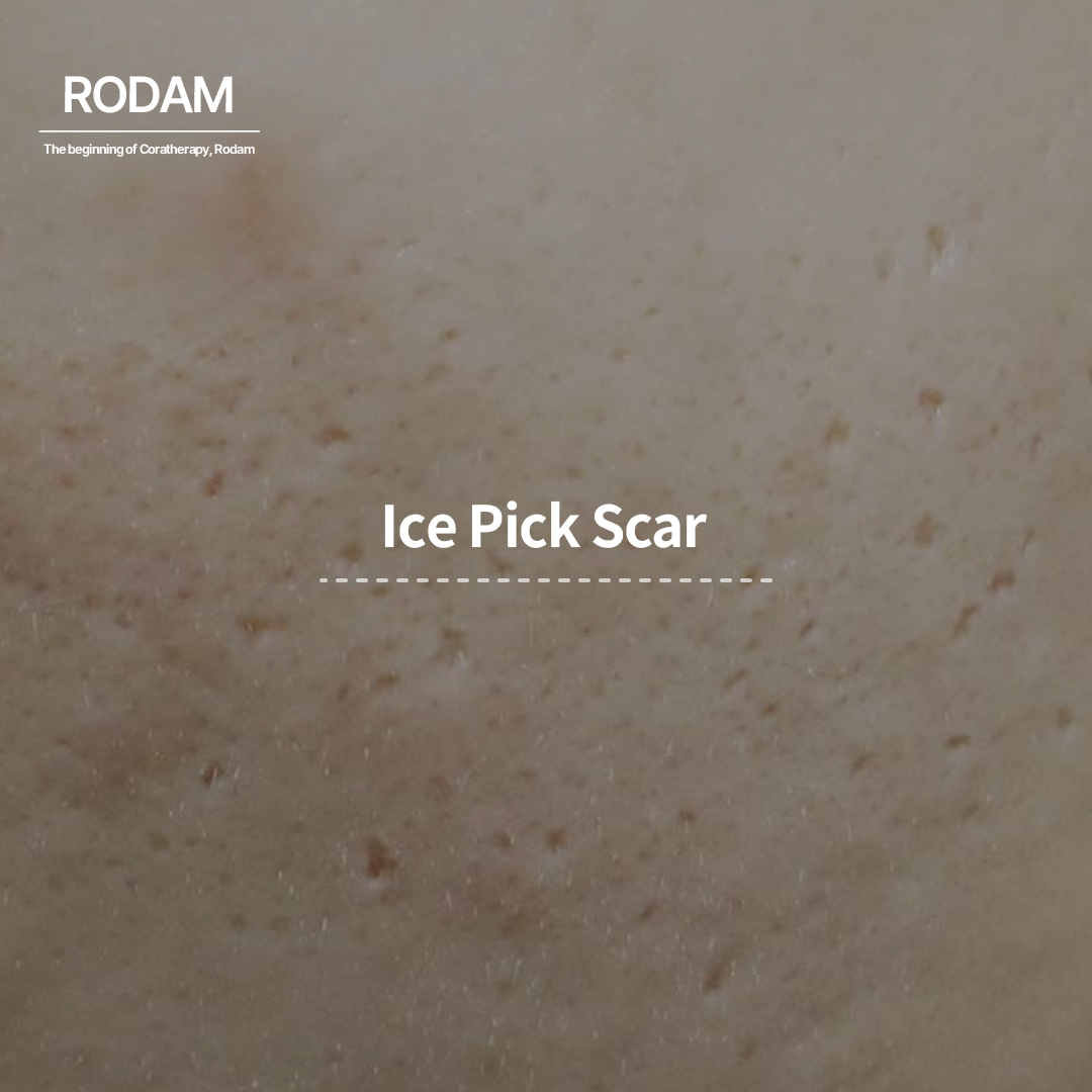 Causes and Treatment of Ice Pick Scars at Rodam Korean Medicine Clinic ...
